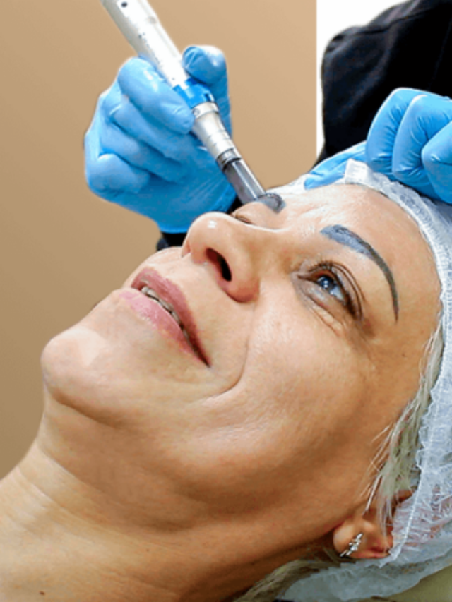 Microagulhamento: conheça os principais benefícios desta técnica ...