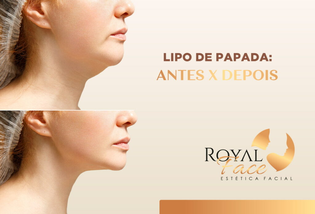 Antes e depois da Lipo de Papada - Royal Face