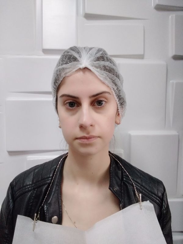 Preenchimento Facial Para Olheiras Antes E Depois Do Tratamento