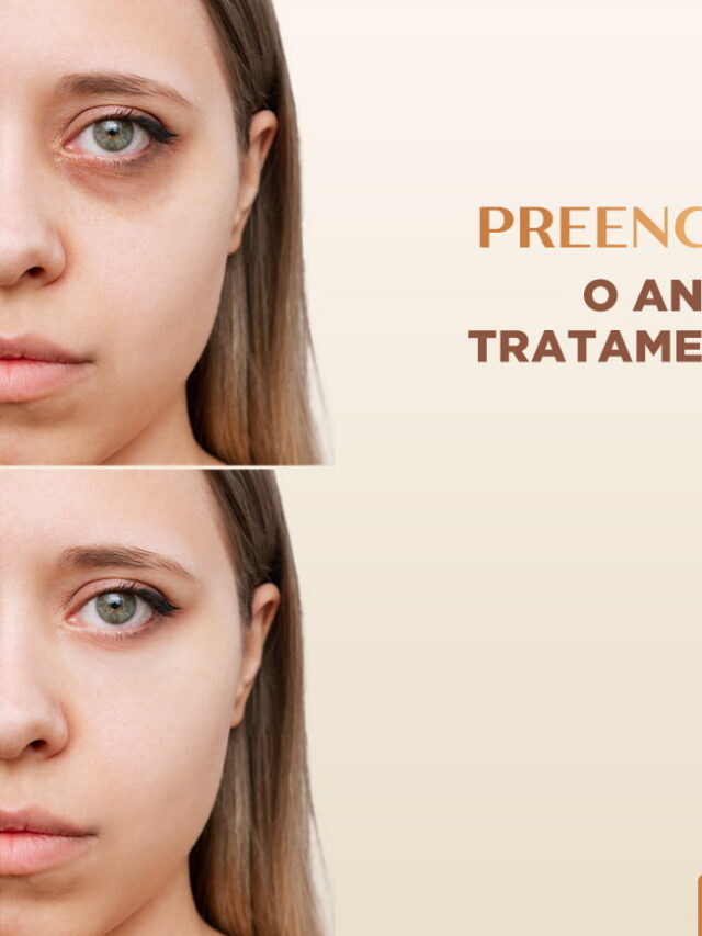 Preenchimento Facial Antes E Depois Do Tratamento Para Olheiras