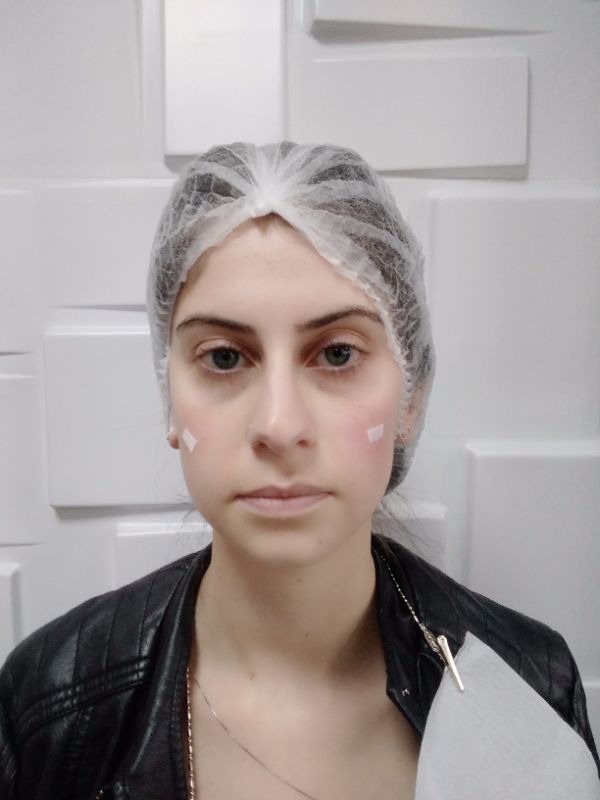 Preenchimento Facial Antes E Depois Do Tratamento Para Olheiras