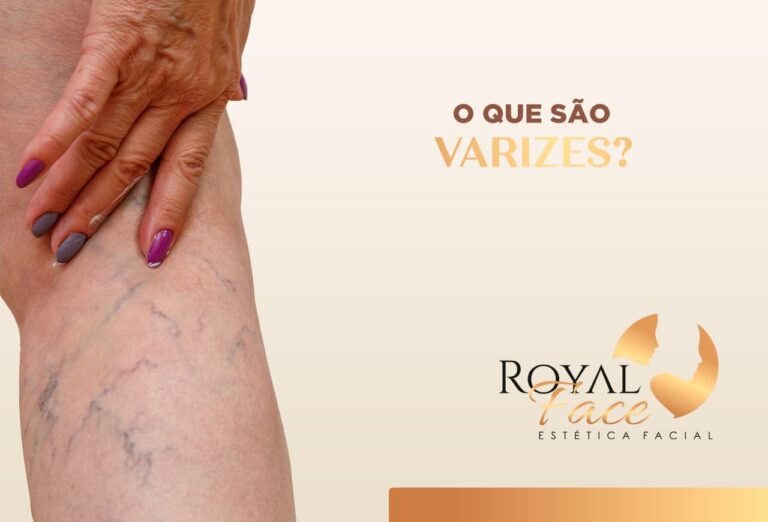 O que são as varizes? A Royal Face te explica!