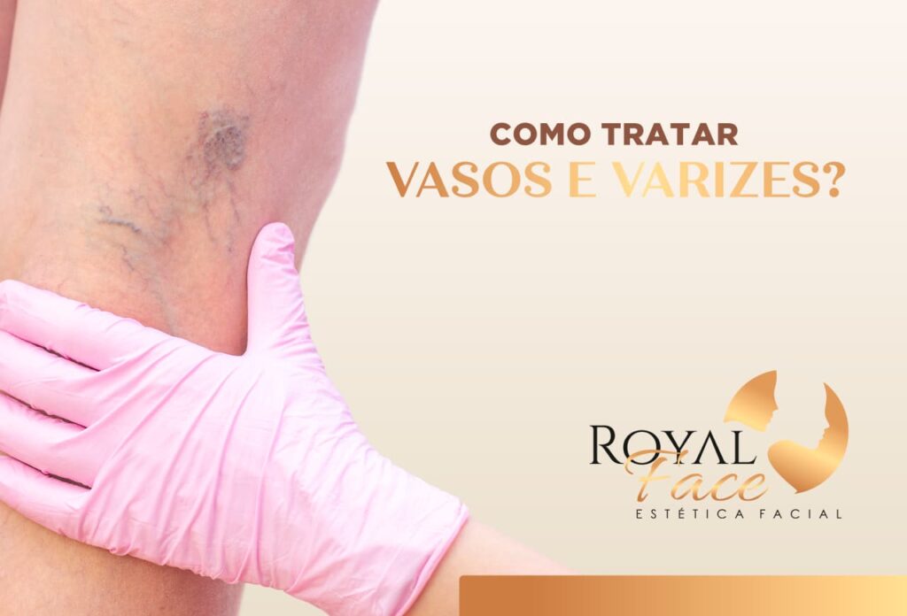 Varizes e Vasos: Conheça alguns tratamentos disponíveis