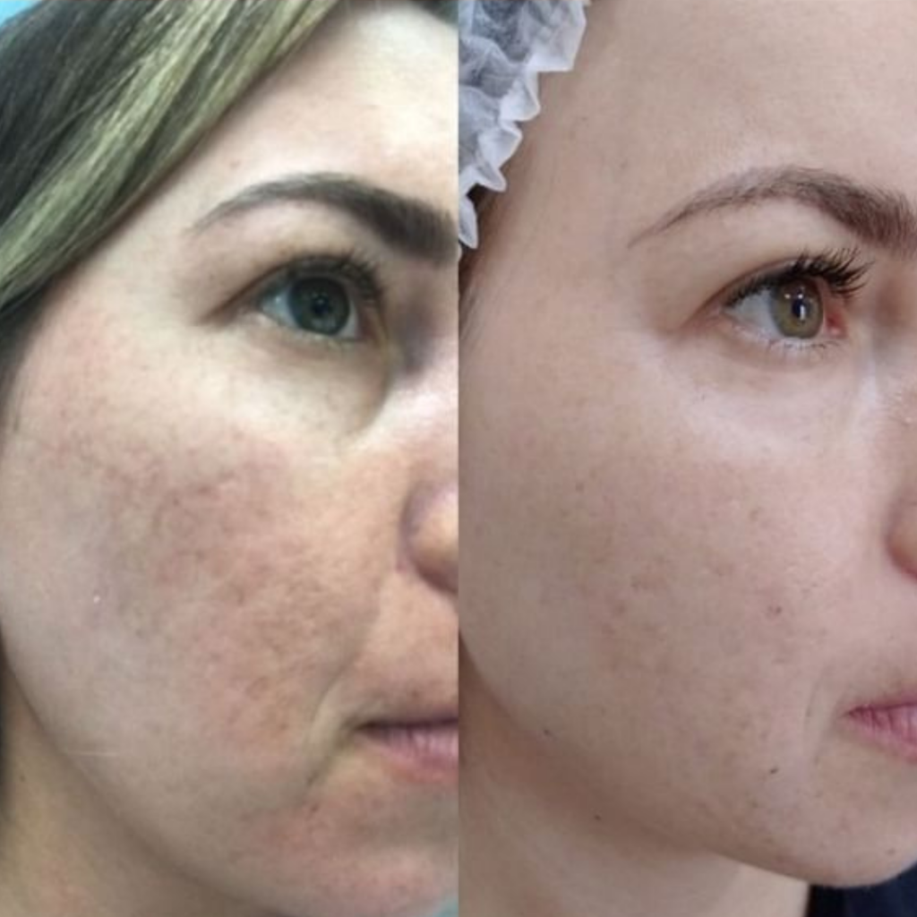 Microagulhamento - Royal Face | Clínica de Estética Facial