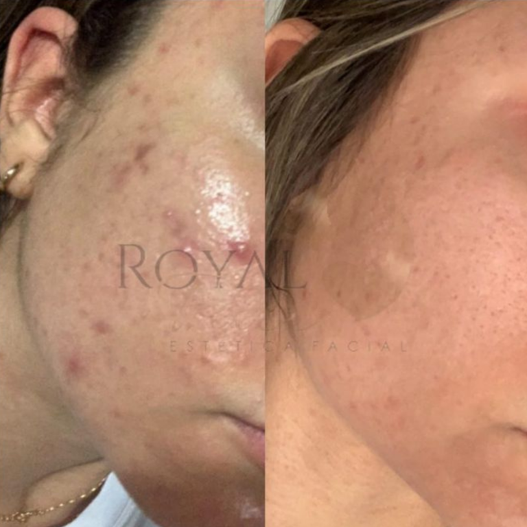 Microagulhamento - Royal Face | Clínica de Estética Facial