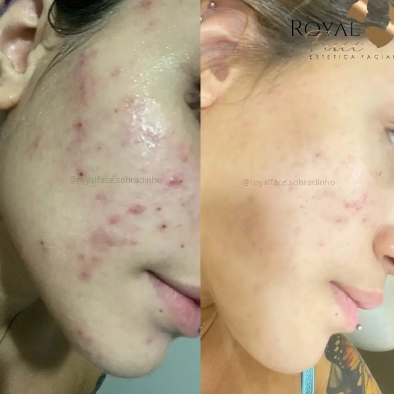 Microagulhamento - Royal Face | Clínica de Estética Facial
