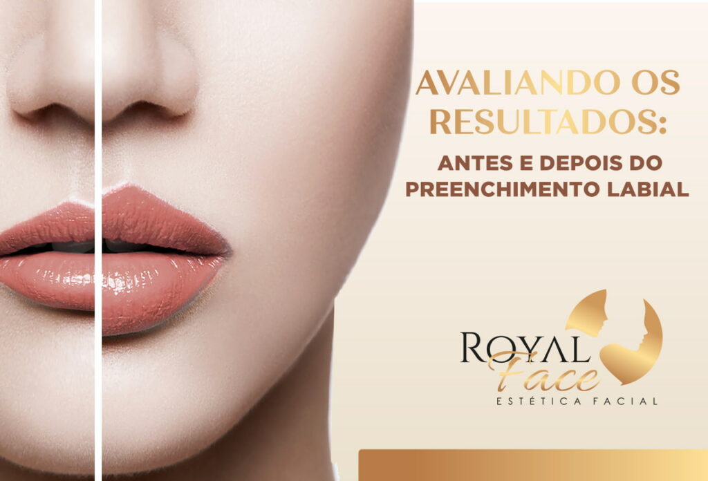 Antes e depois do preenchimento labial: Avaliando os resultados