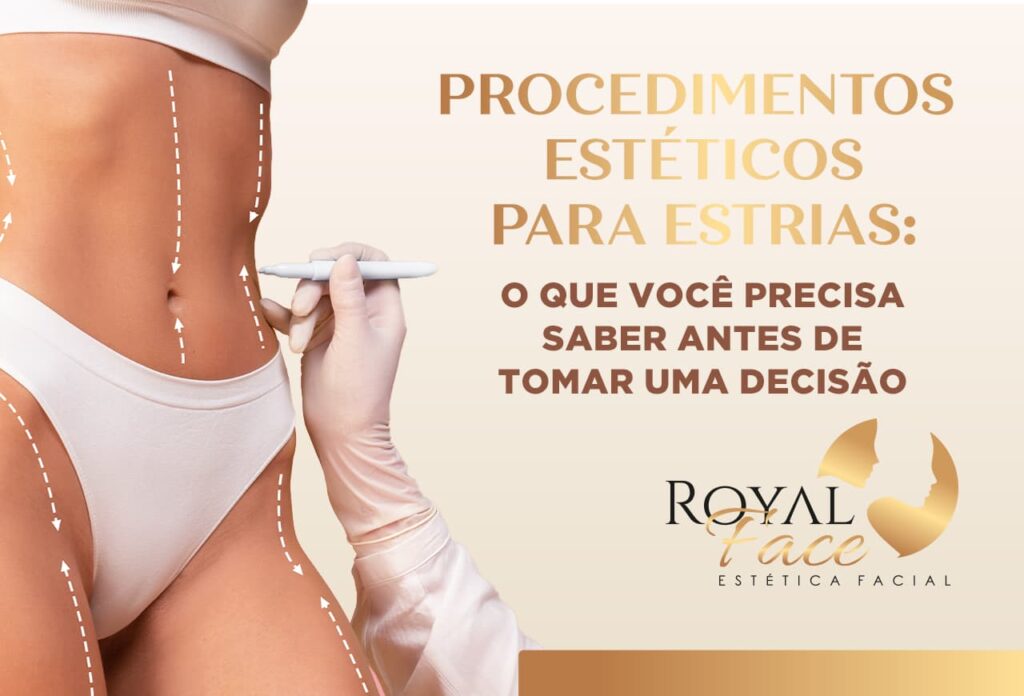 Procedimentos estéticos para estrias: Tudo que você precisa saber