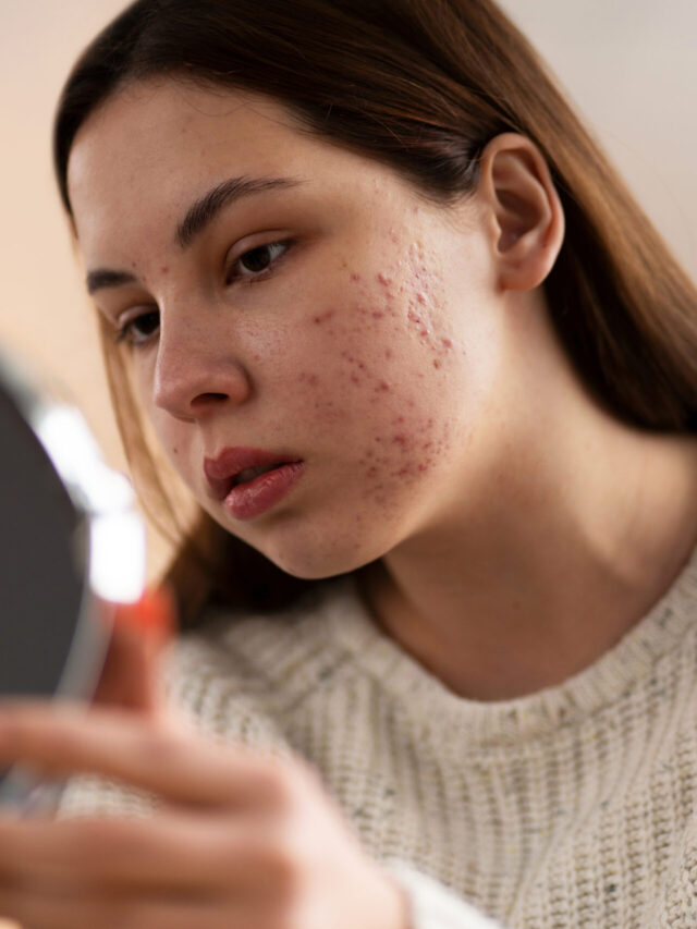 Como acabar com as cicatrizes de acne? Conheça a enzima que pode livrar ...
