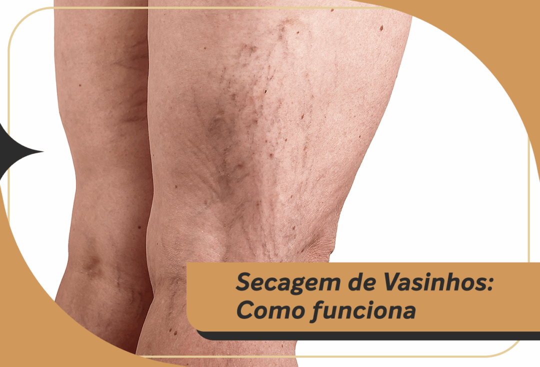Secagem de Vasinhos: Como é e cuidados no pós procedimento
